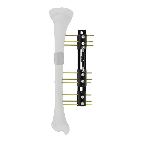 Tibia external fixation system - LRS - Peditst - femur / tubular ...