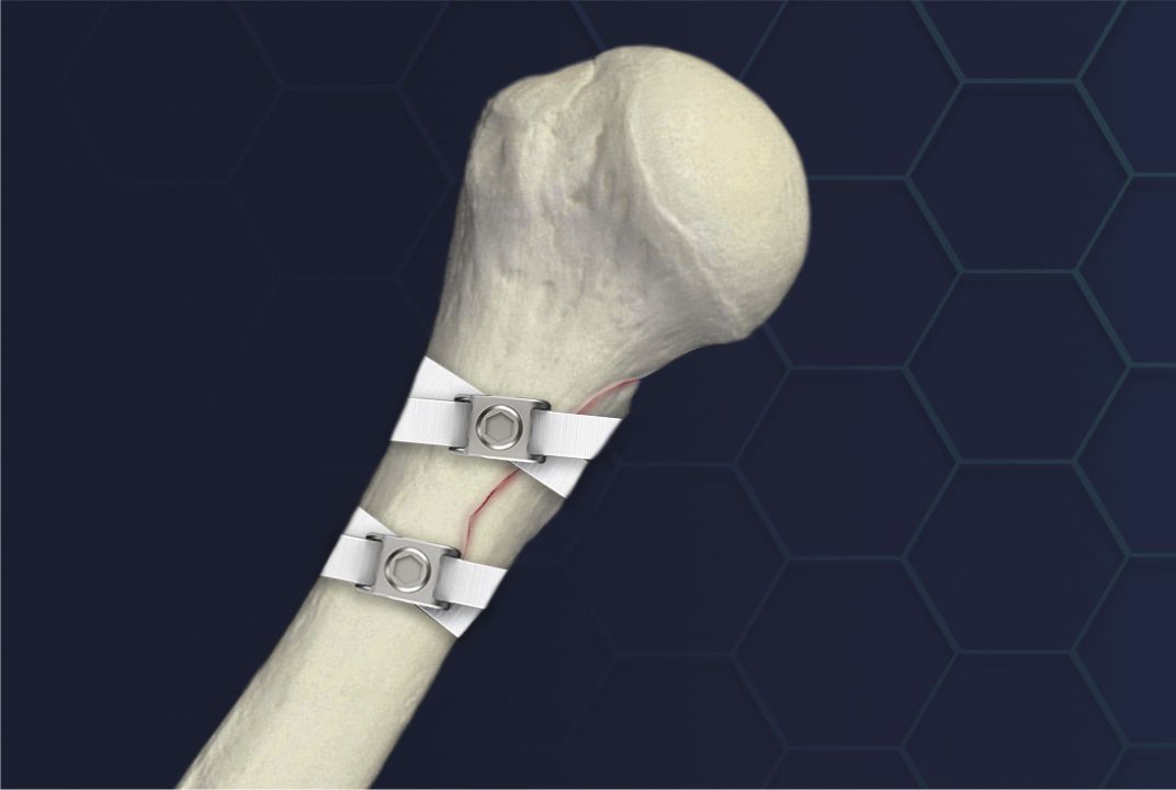 Multifilament polymer bone cerclage wiring - Ortholox® UHMWPE - Ortolog ...