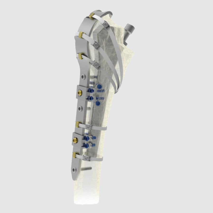 Femoral periprosthetic plate - Ortholox® - Ortolog Medikal - proximal / locking / titanium