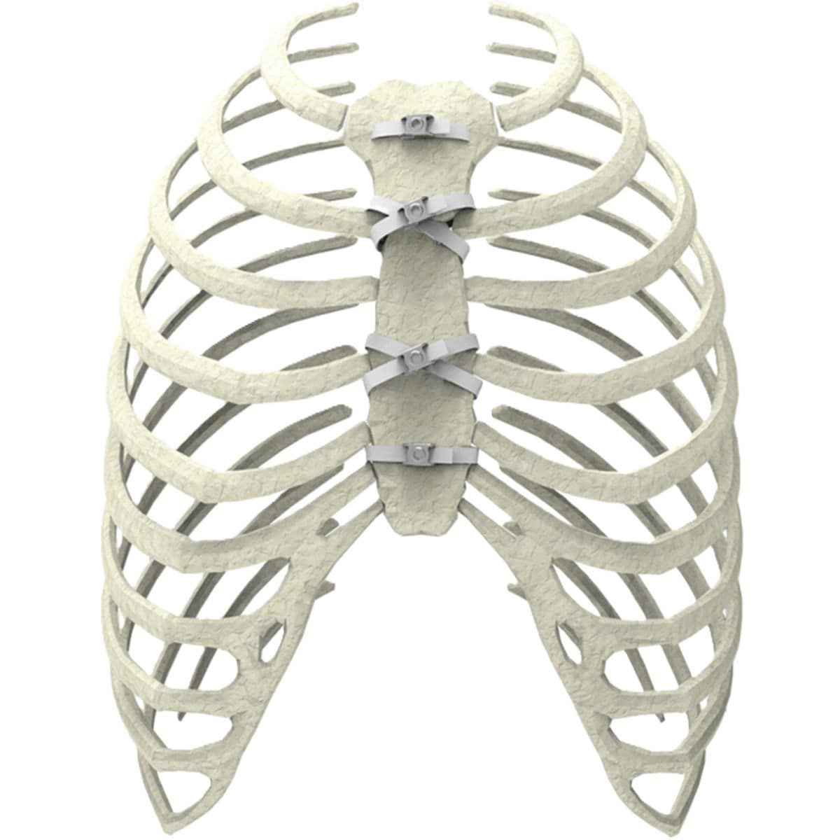 Sternal closure bone cerclage wiring - Ortholox® UHMWPE - Ortolog ...