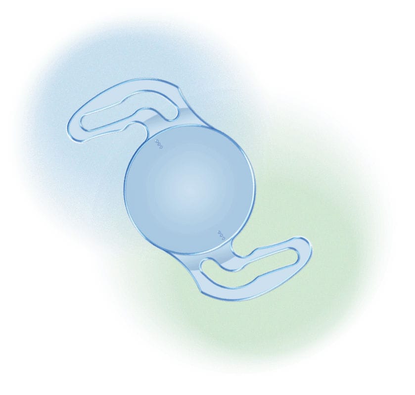 Toric intraocular lens - EVToric - Aurolab - astigmatism