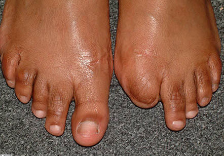 Toe cosmetic prosthesis - Medical Art Prosthetics - adult