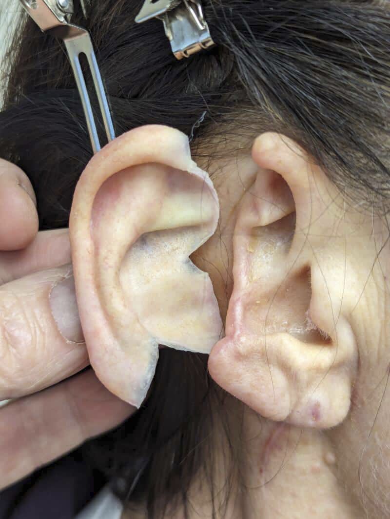 Auricular cosmetic prosthesis - Elegant - Medical Art Prosthetics ...