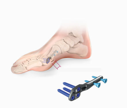 Hallux valgus osteotomy plate - Centrolock® - novastep - lateral ...