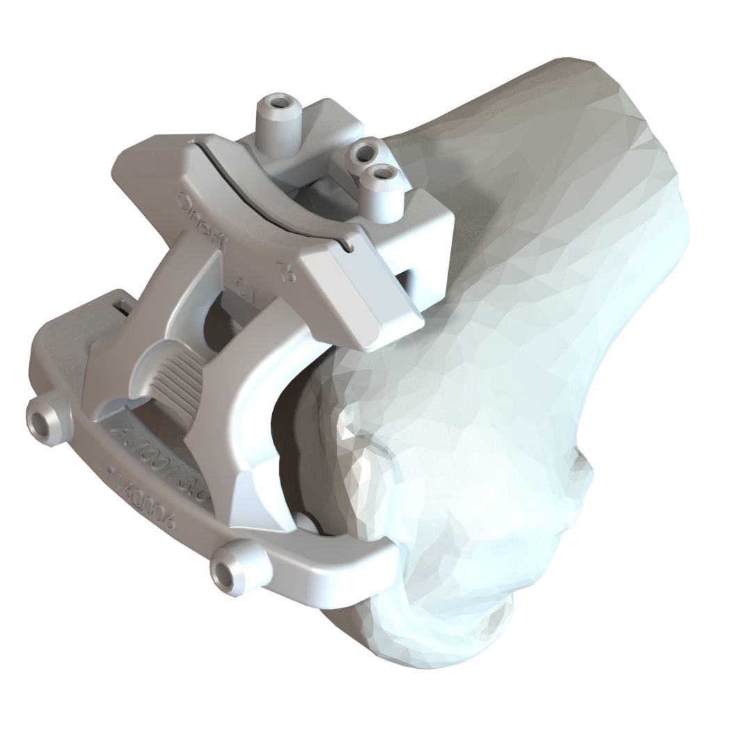 Knee prosthesis resection guide - PERFETTO - Gruppo Bioimpianti