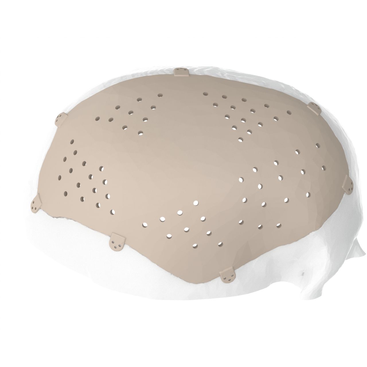 Custom-made cranial implant - Kune Implants