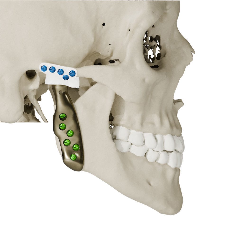 Custom-made temporomandibular implant - Craniotech