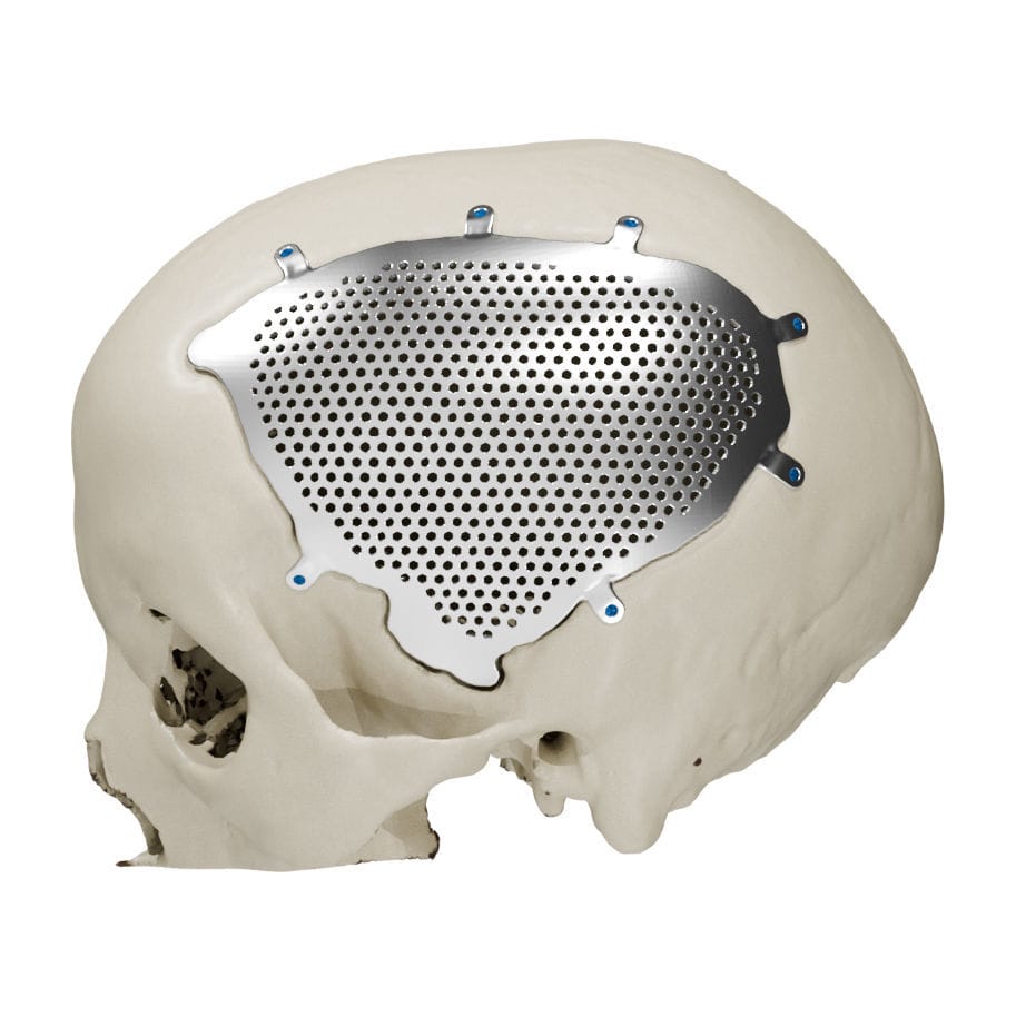 Custom-made cranial implant - Craniotech