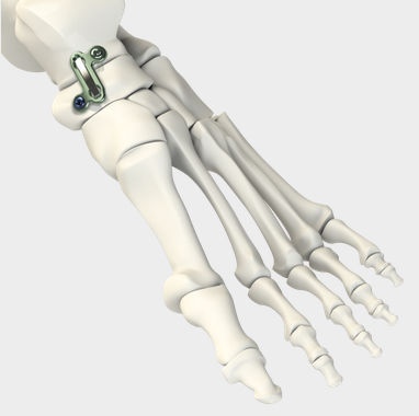Talonavicular joint arthrodesis plate - DynaFORCE® T/N FUSION ...