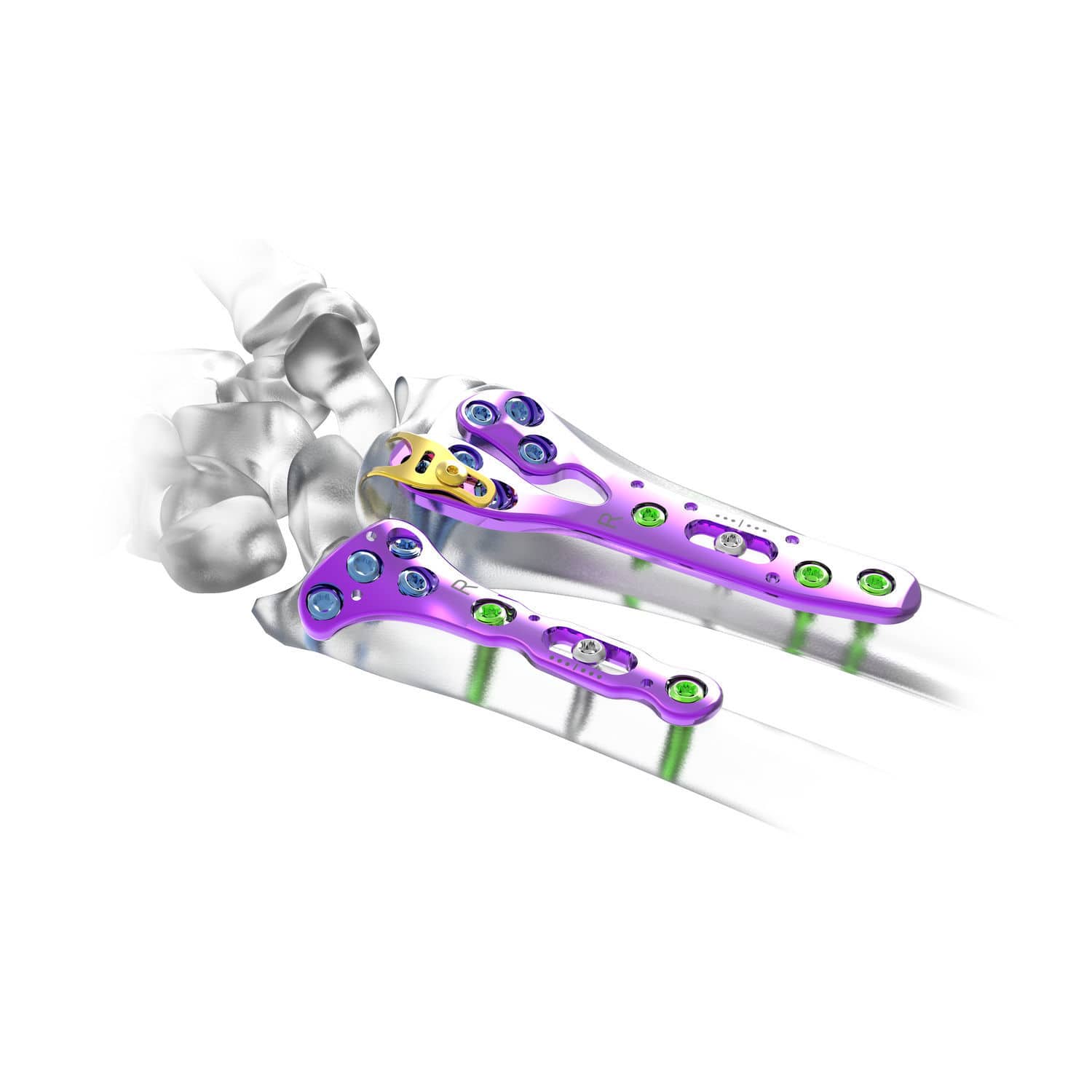 Wrist compression plate - 26.24 series - Astrolabe - distal / locking ...