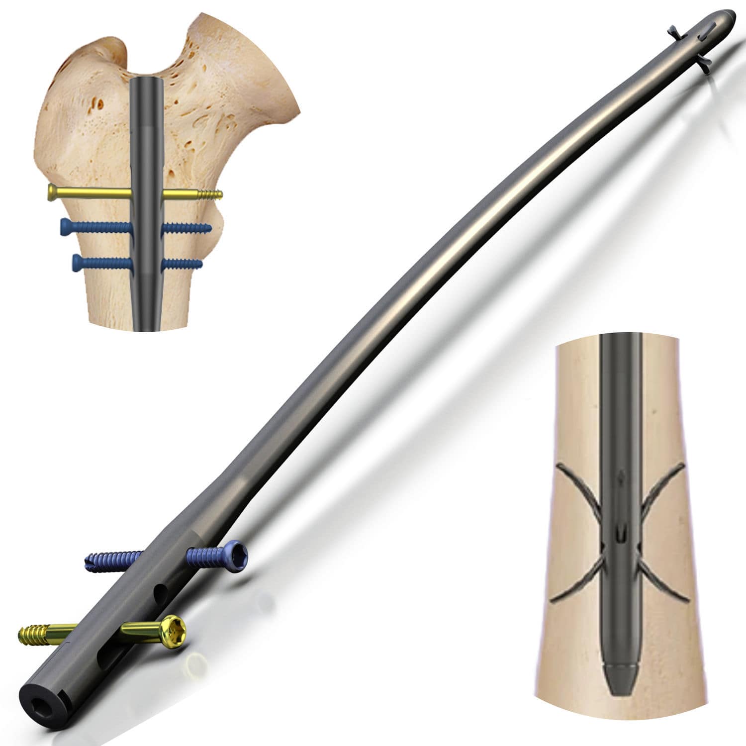 Femoral intramedullary nail - Navy A/R - Dunitech - proximal fixation ...