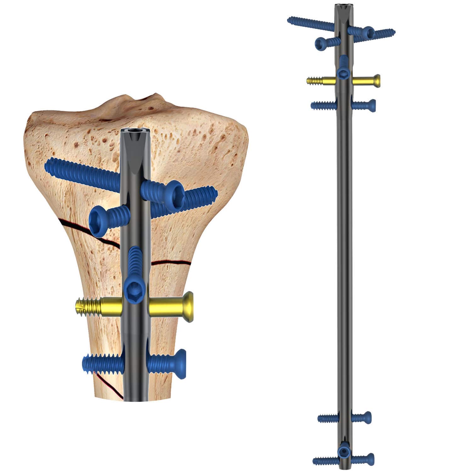 Tibial intramedullary nail - Nite-S - Dunitech - proximal fixation ...