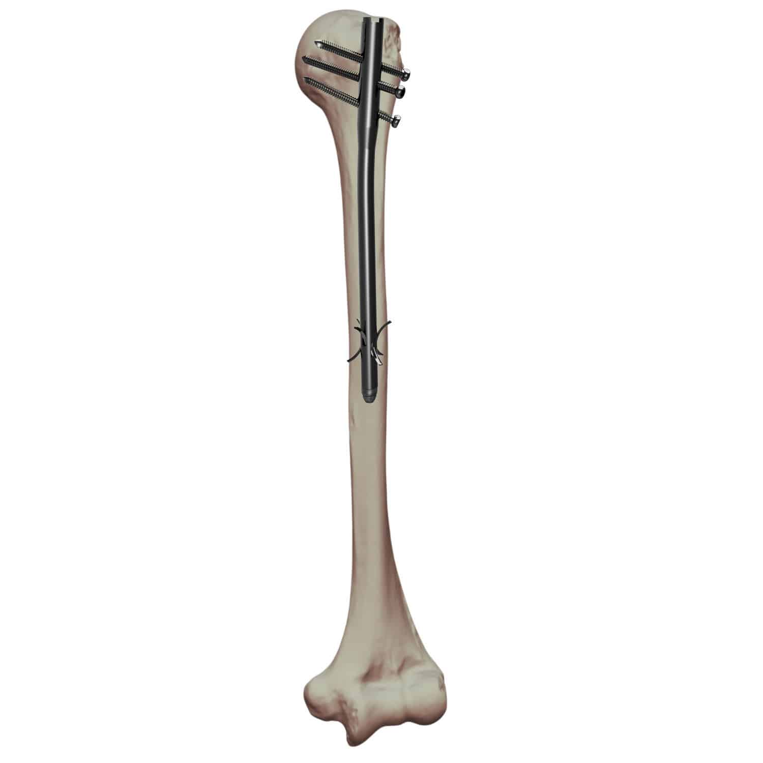 Humeral intramedullary nail - NUNA - Dunitech - mid-shaft fixation ...