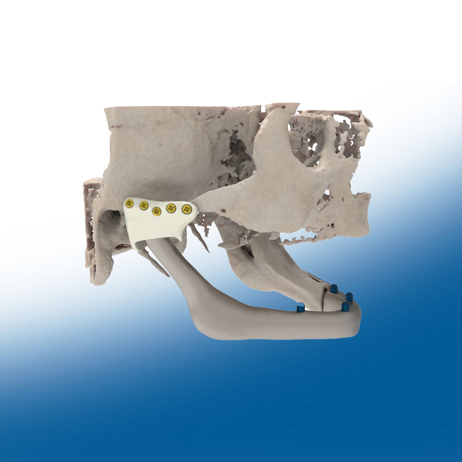 Custom-made temporomandibular implant - TMJ - Ortho Baltic Implants