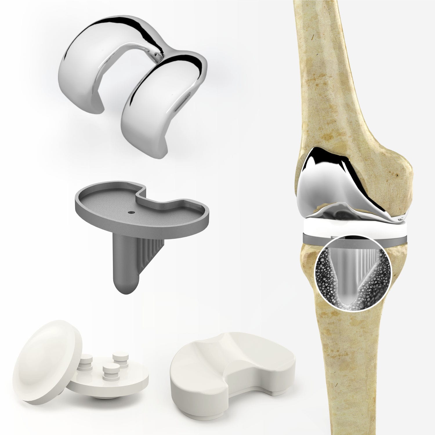 Total knee prosthesis - Zimed Medical - sliding, cruciate-retaining ...