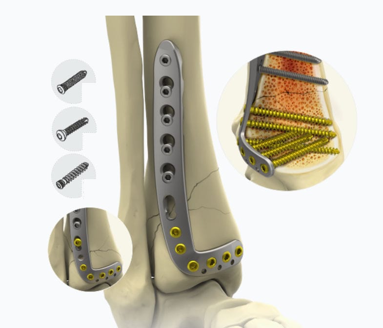 Tibia compression plate - 10132 series - Zimed Medical - distal ...