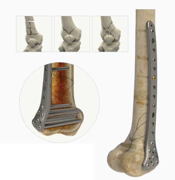 Femur compression plate - 1542 series - Zimed Medical - distal ...