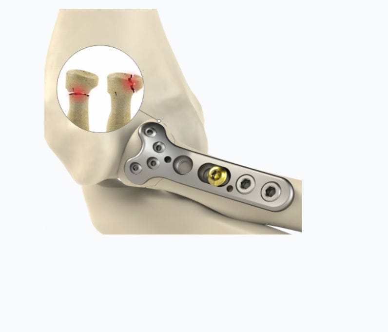 Radius compression plate - 8762 series - Zimed Medical - radial head ...