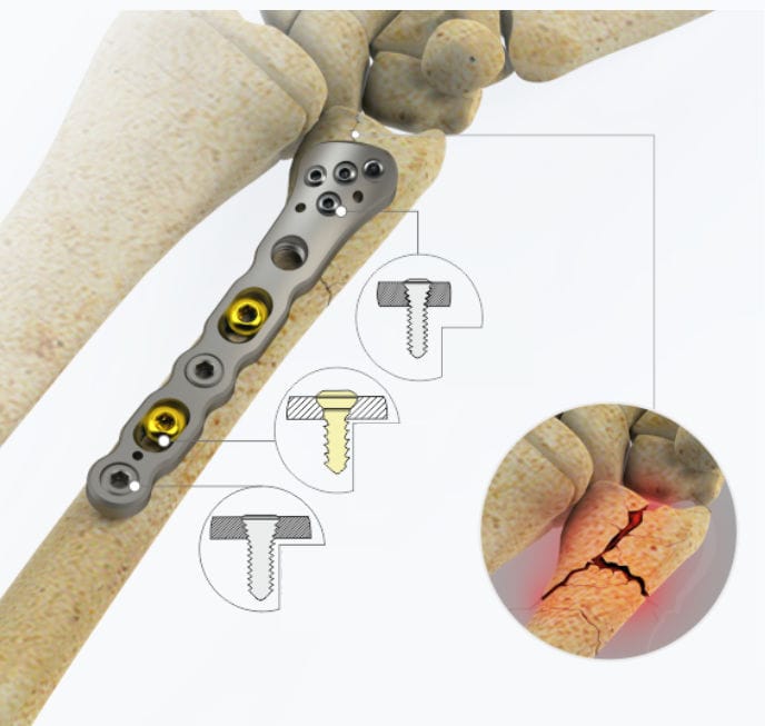 Ulna compression plate - 8732 series - Zimed Medical - distal / locking ...