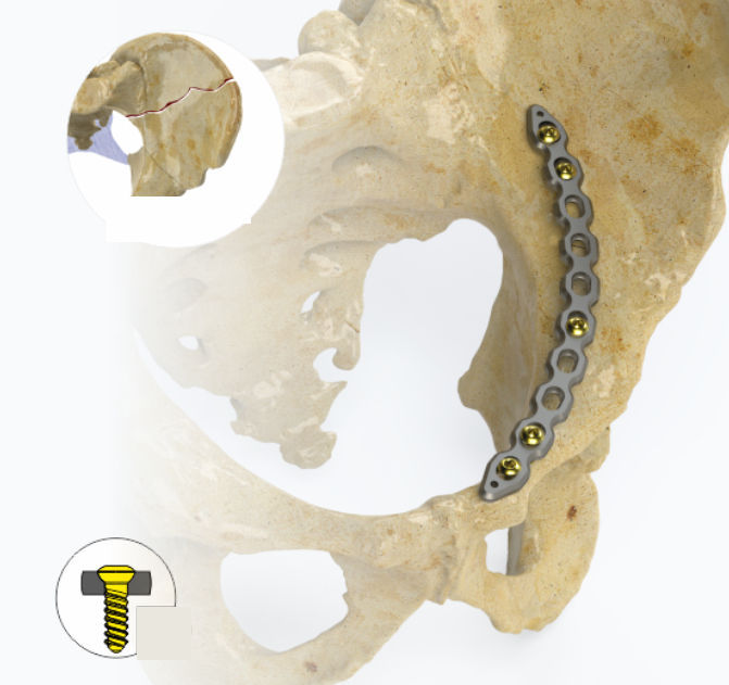 Small bone fragment compression plate - 1932 series - Zimed Medical ...