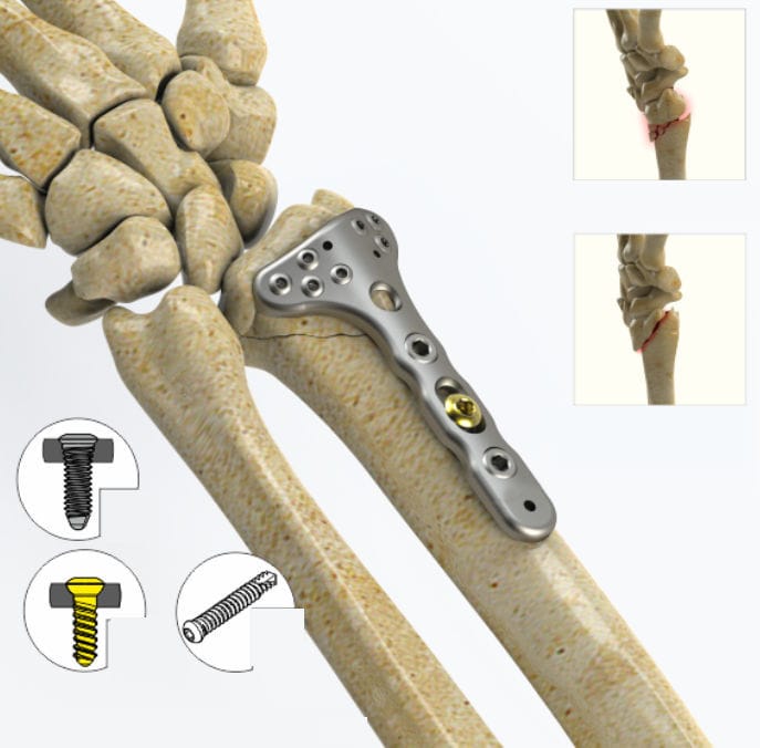 Radius compression plate - 1992 series - Zimed Medical - distal ...