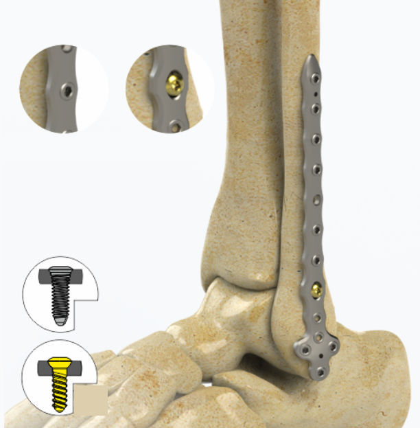 Fibula compression plate - 1852 series - Zimed Medical - distal ...