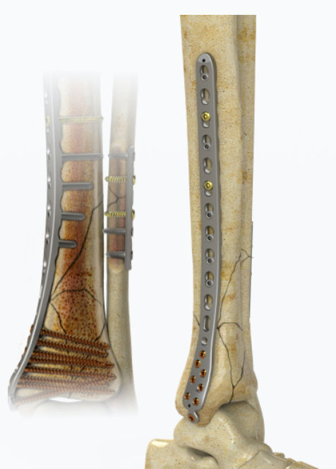 Tibia compression plate - 1412 series - Zimed Medical - distal / medial ...