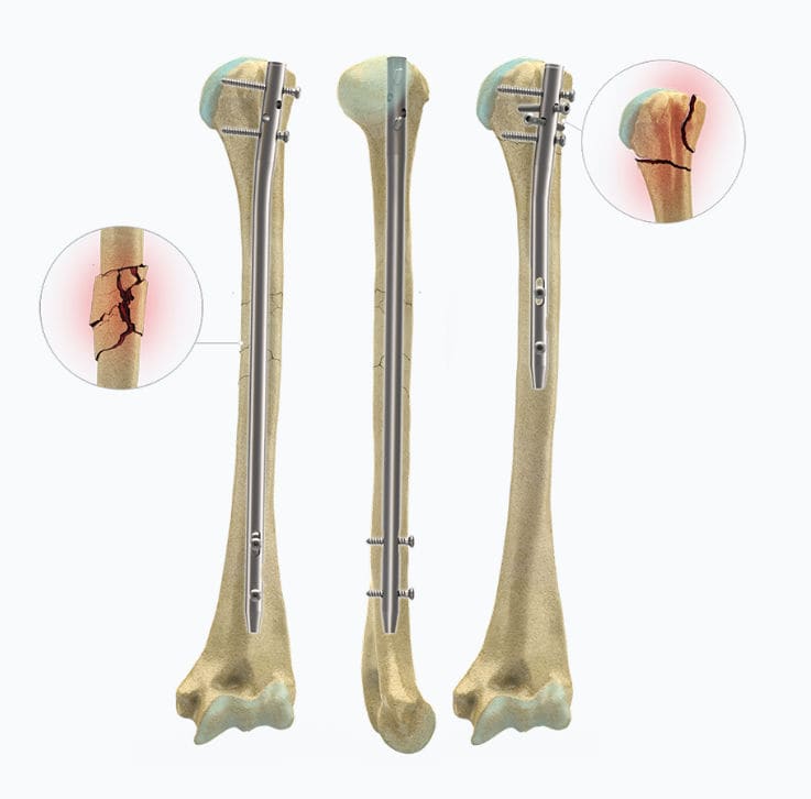 Humeral intramedullary nail - 4102 series - Zimed Medical - metallic