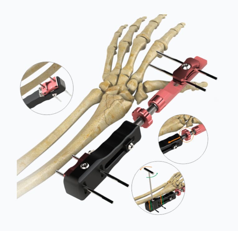 Wrist external fixation system - 5508-0000 - Zimed Medical - tubular ...