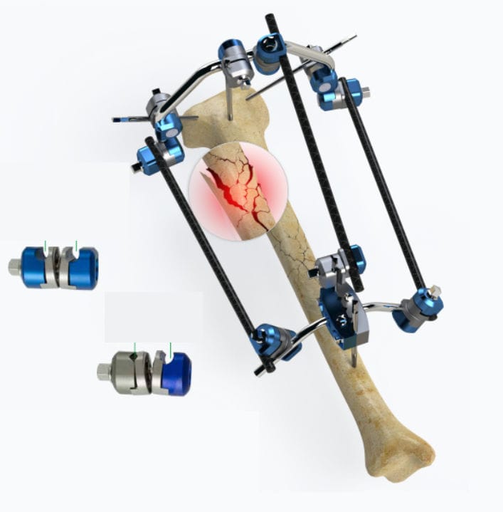 Tibia external fixation system - Zimed Medical - circular / adult