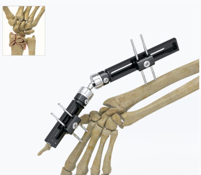 Wrist external fixation system - 5034 series - Zimed Medical - tubular ...