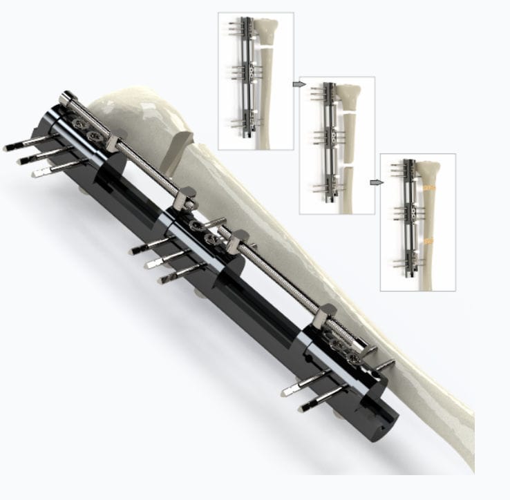 Tibia external fixation system - 5074 series - Zimed Medical - tubular ...