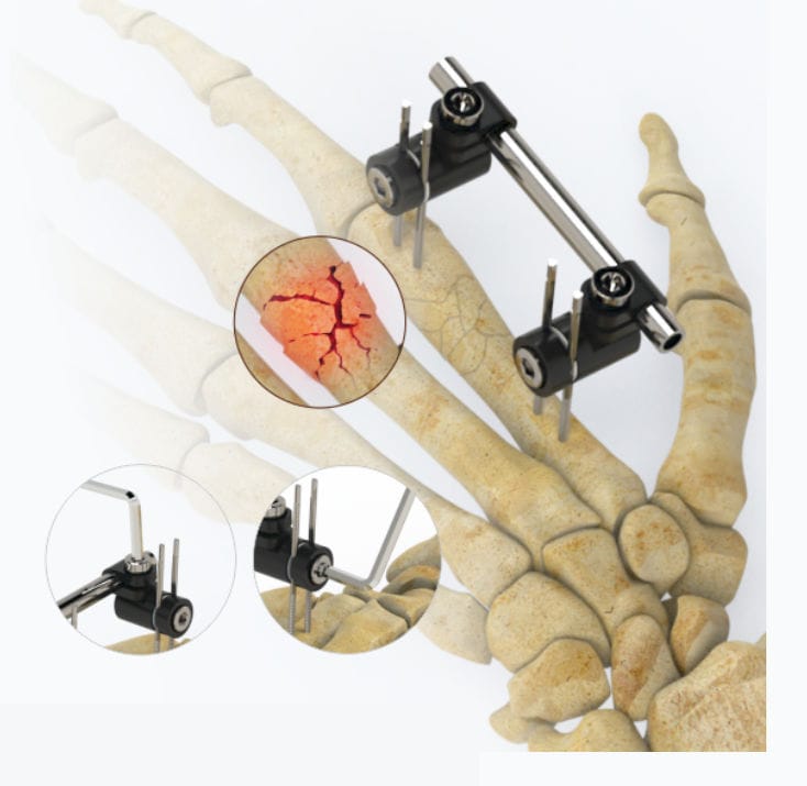 Metatarsophalangeal joint external fixation system - 5884-0000 - Zimed ...