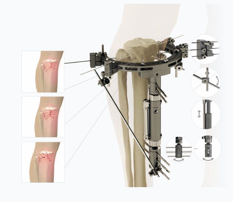 Tibia external fixation system - 5254 series - Zimed Medical - hybrid ...