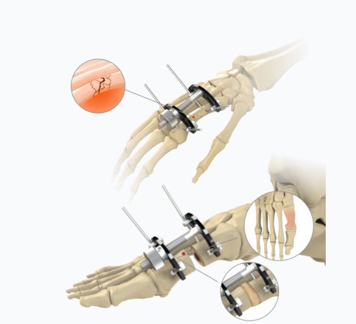 Metatarsophalangeal joint external fixation system - 5784-0000 - Zimed ...