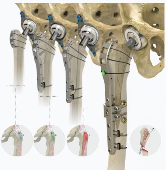 Femur compression plate - Zimed Medical