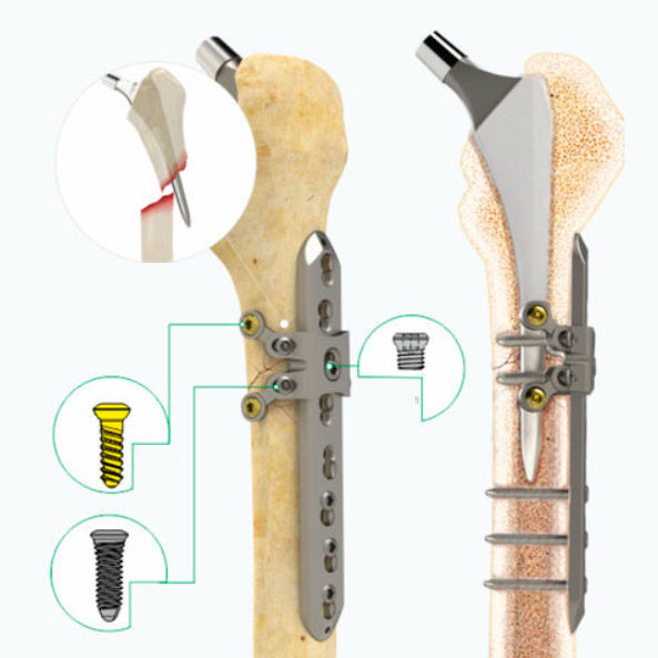 Tibia compression plate - 2912 Series - Zimed Medical - locking