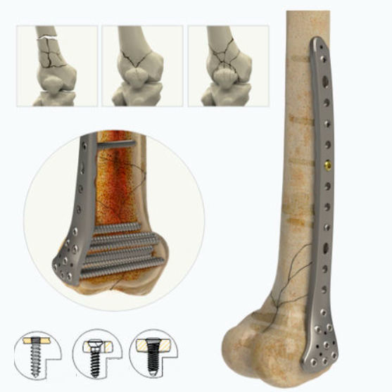 Femoral compression plate - Zimed Medical - distal / lateral / locking