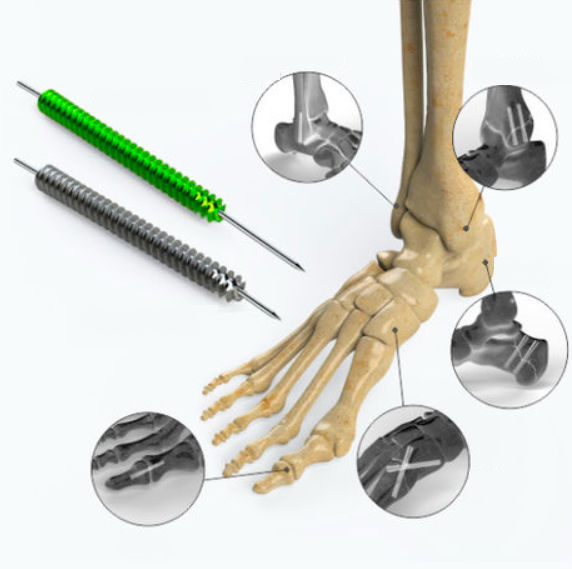 Foot compression bone screw - Zimed Medical - cannulated / headless