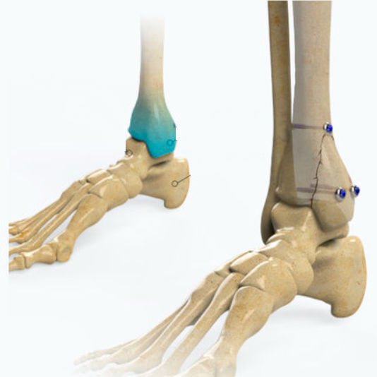 Foot compression bone screw - Zimed Medical - cannulated