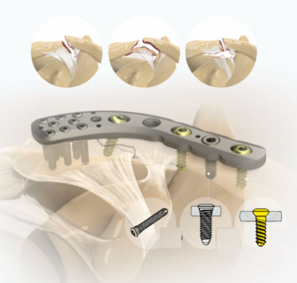 Clavicle compression plate - 1492 series - Zimed Medical - distal ...