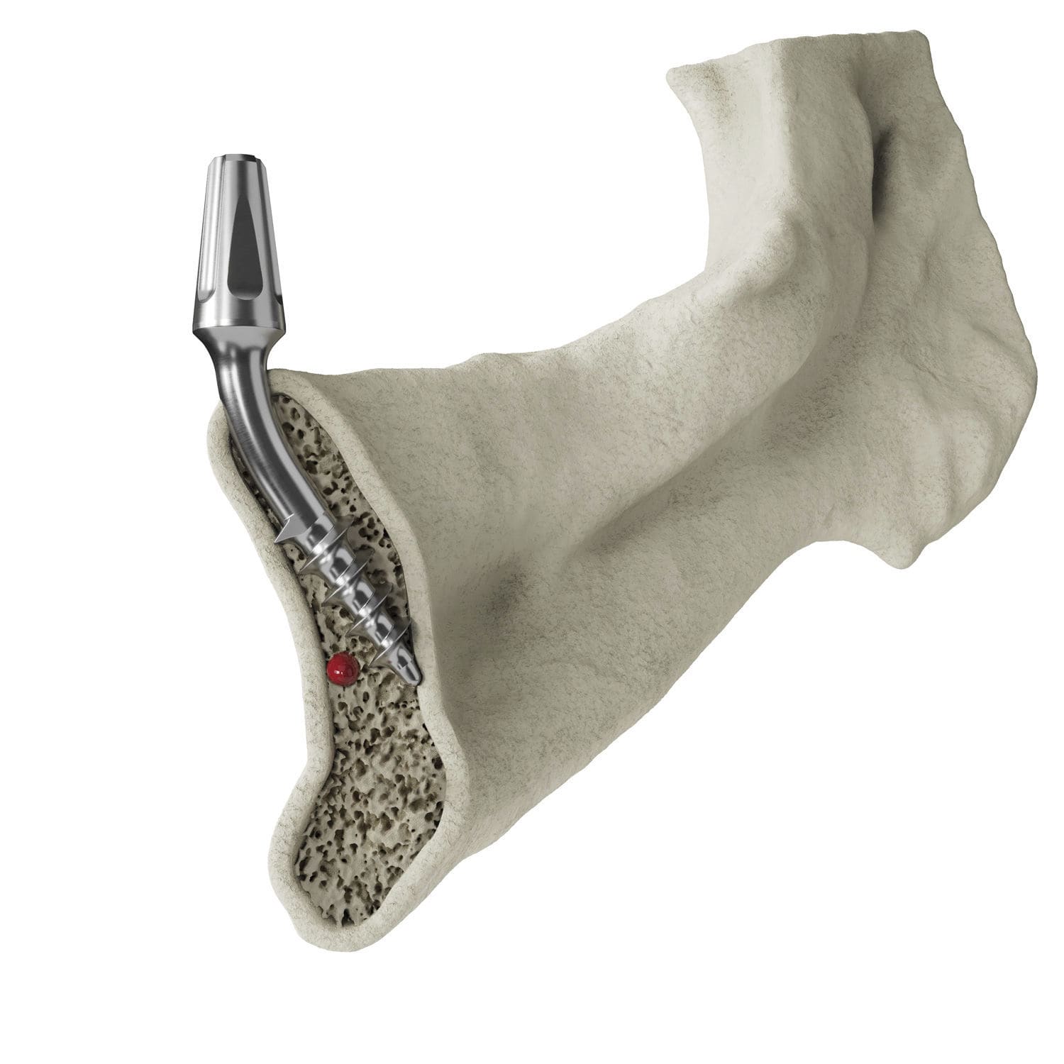 Cylindro-conical dental implant - Basal - NSI srl - titanium / external ...