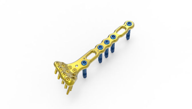 Wrist Compression Plate True Lock Truemed Medical Distal