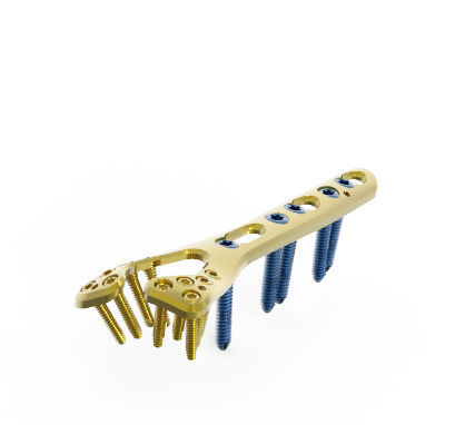 Radius compression plate - TRUE LOCK - Truemed Medical - distal ...