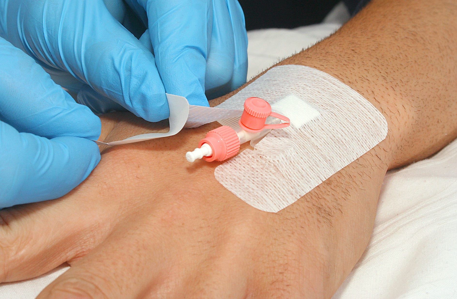Adhesive catheter fixation - 8900001 - Transatlantic ...