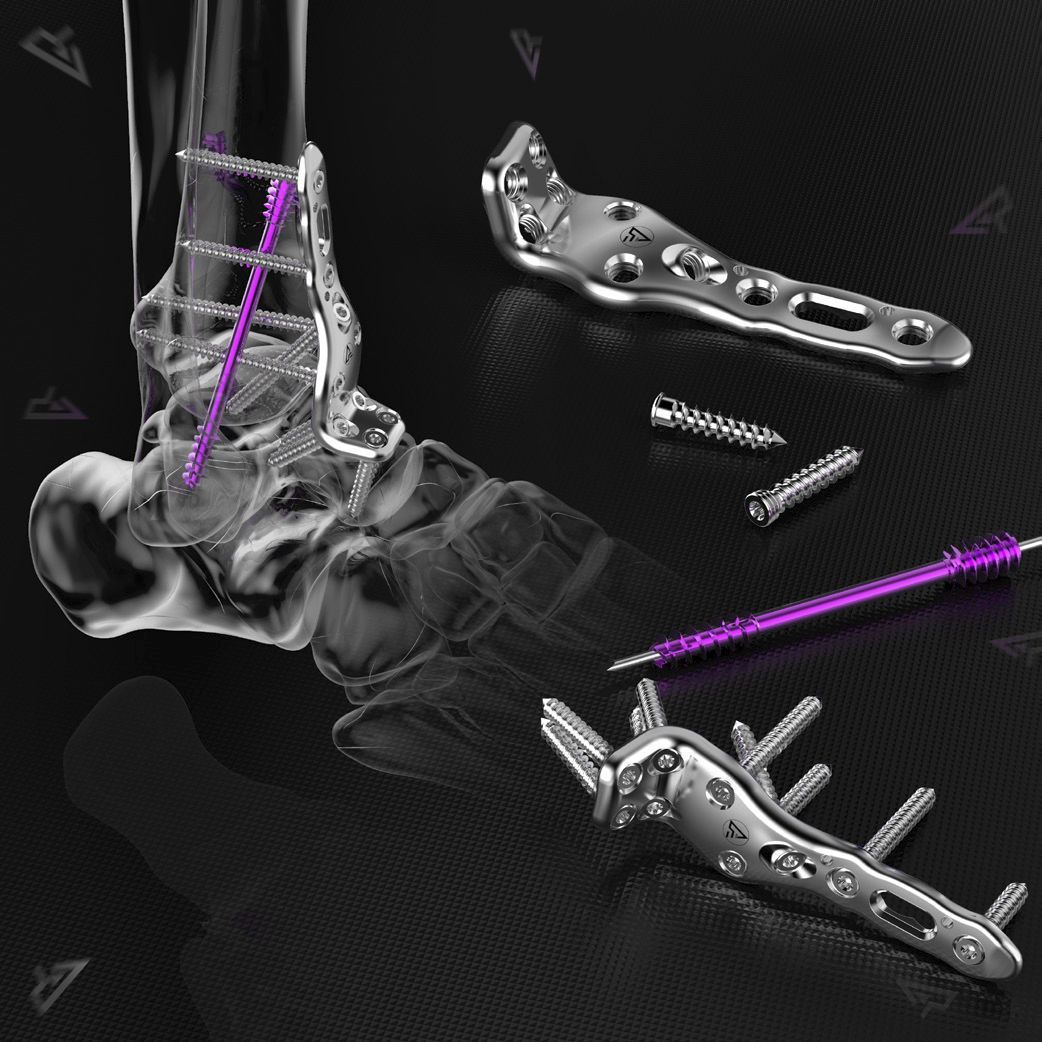 Ankle arthrodesis plate - ANTERIOR PLATING SYSTEM 4.0 - AGOMED Medizin ...