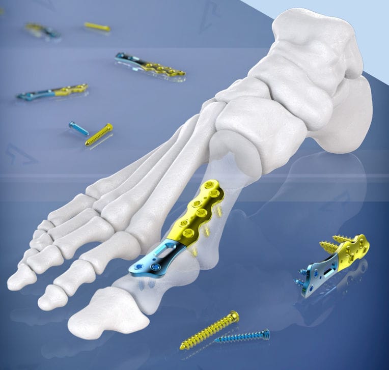 Forefoot compression plate - 400120 series - AGOMED Medizin-Technik ...