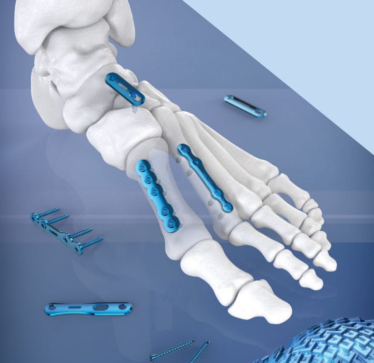 Foot compression plate - Evans - AGOMED Medizin-Technik - ankle ...