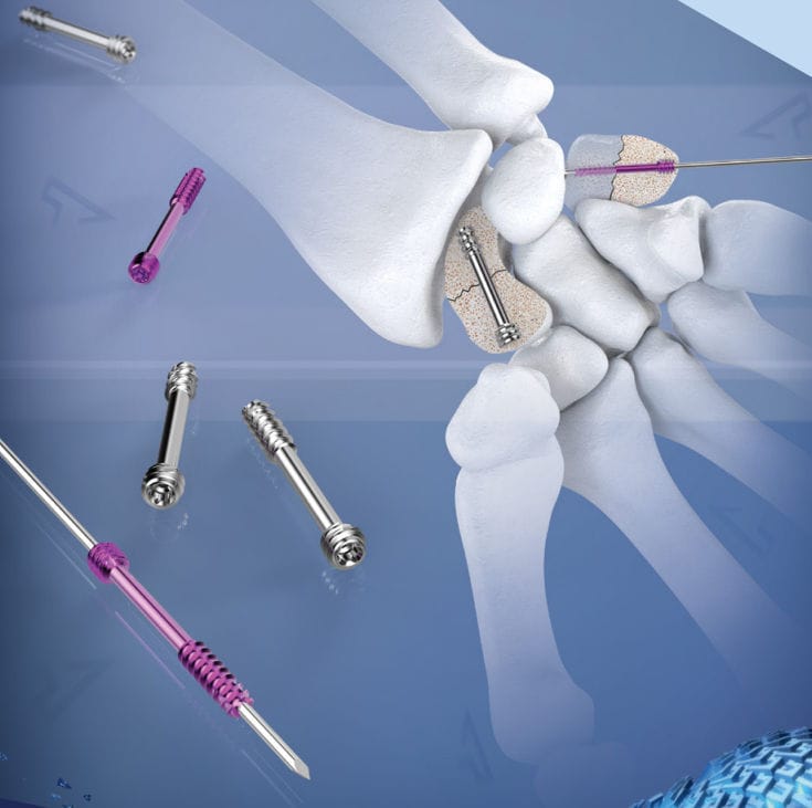 Metacarpal joint compression bone screw - AGOMED Medizin-Technik ...