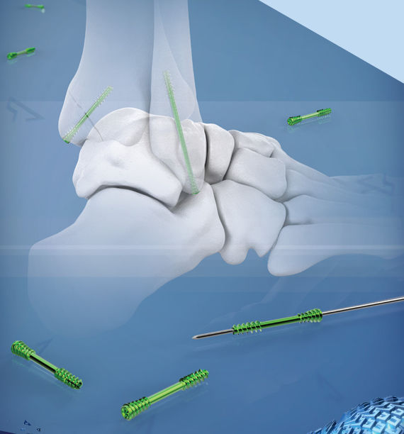 Hand arthrodesis screw - AGOMED Medizin-Technik - foot / ankle / cannulated